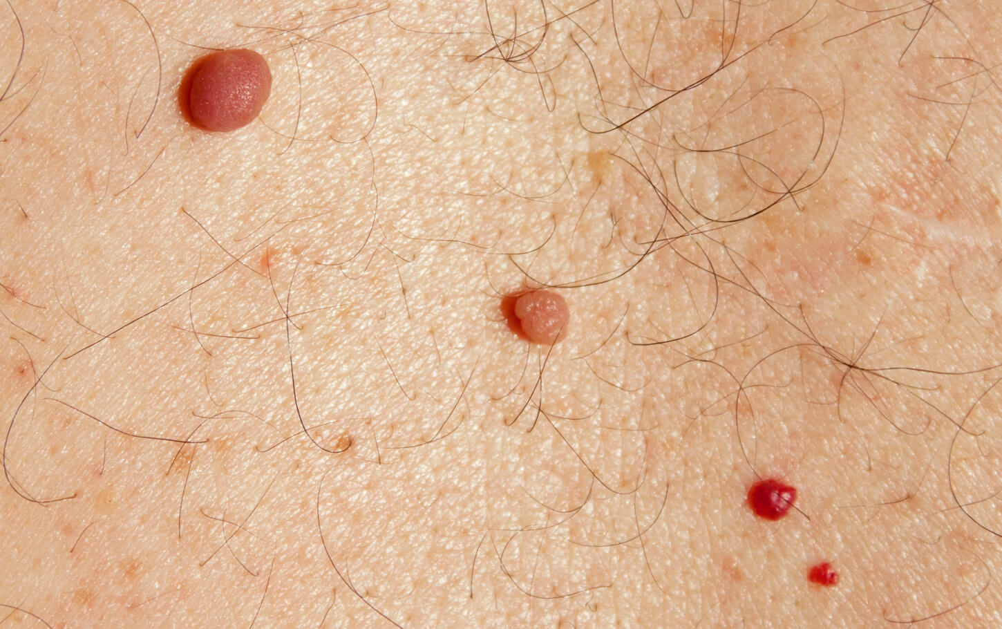 moles-new - Highgrove Clinic