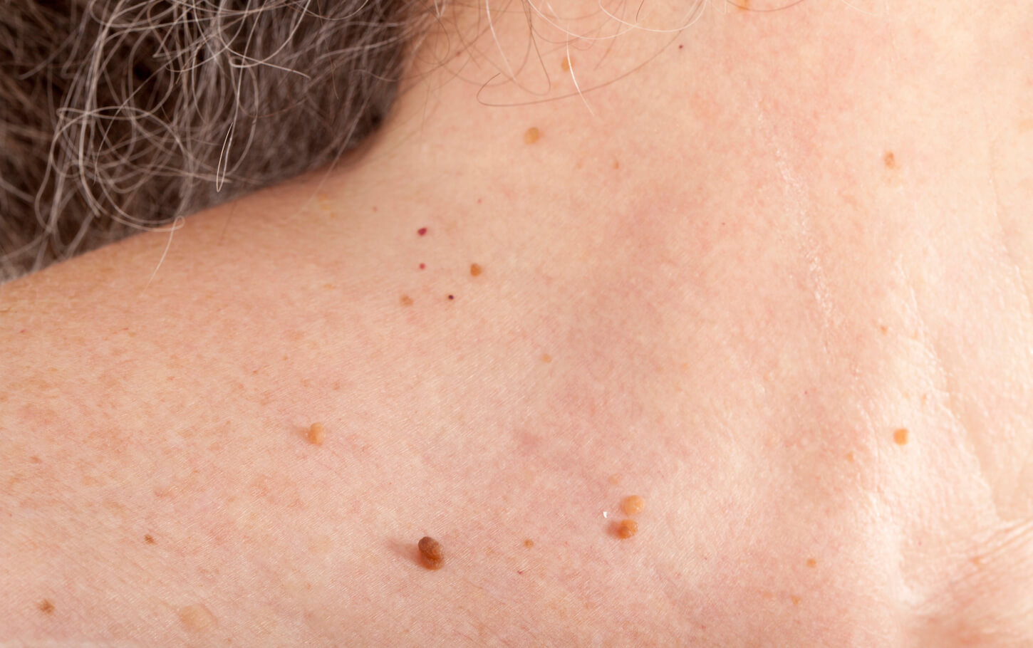 skin-tag - Highgrove Clinic